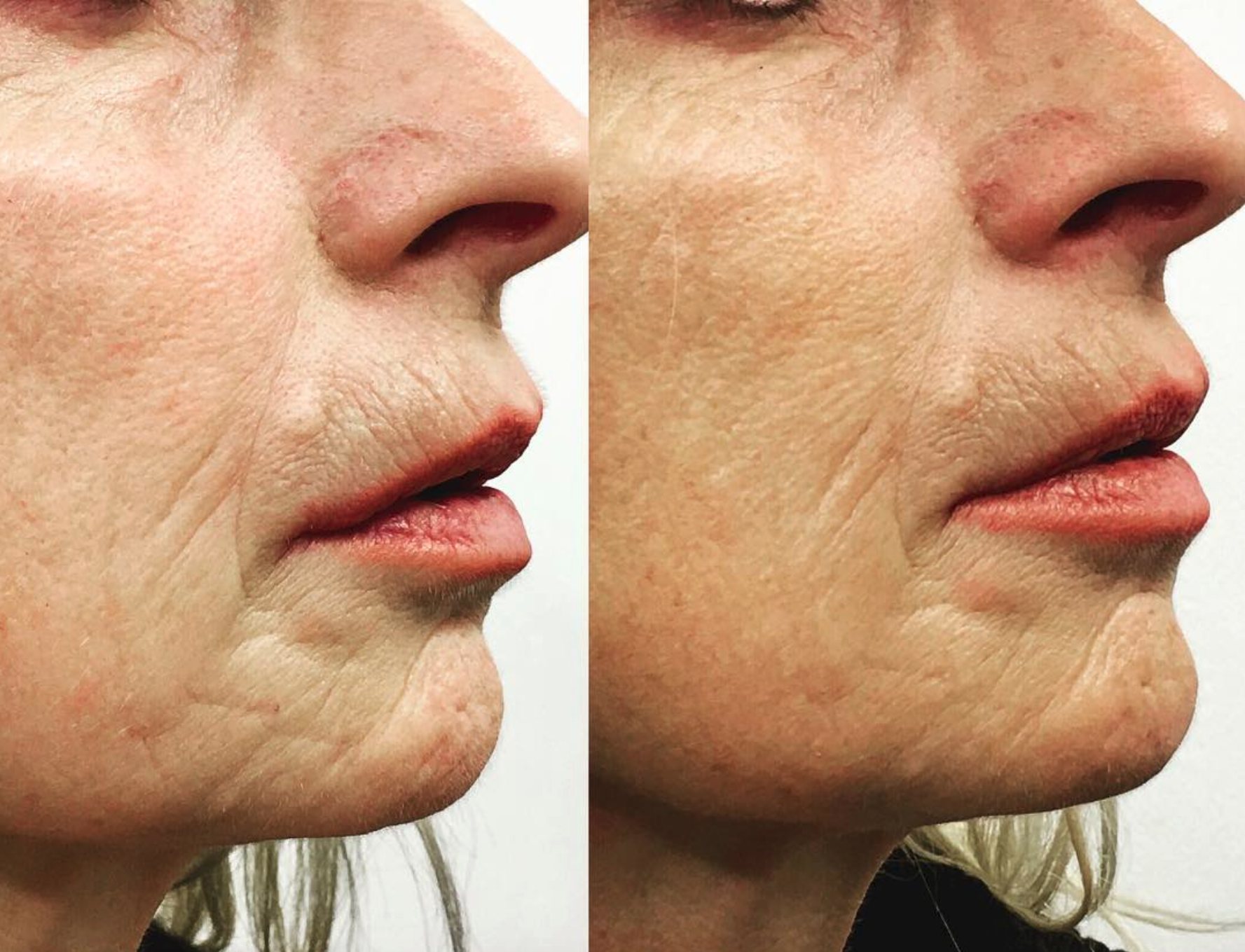 Micro needling SimplySkin Medical Aesthetics